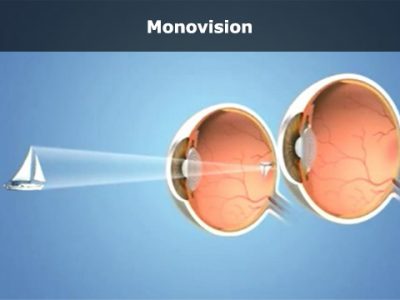 video-posters-monovision - The Eye Center